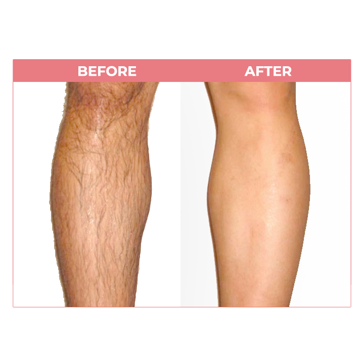 Beeswax Hair Removal Mousse – uber7
